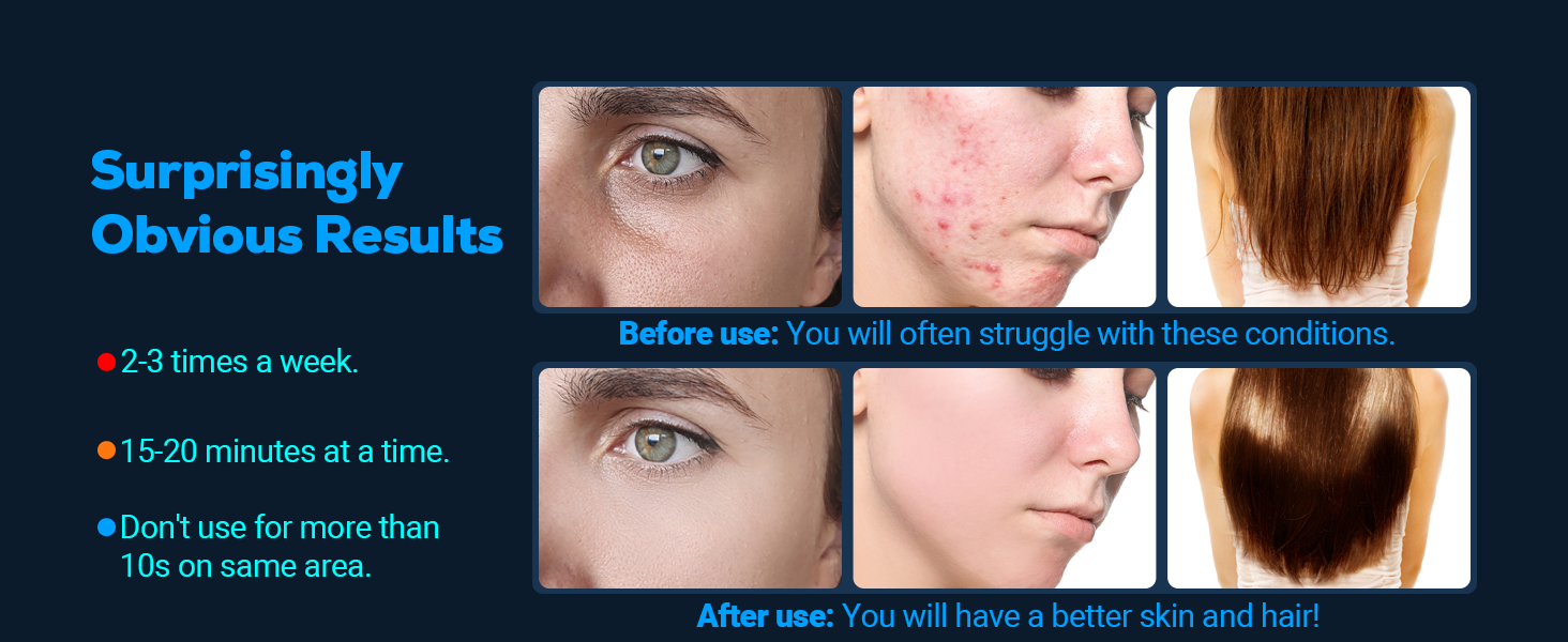 Aparat Electroderm pentru tratament cosmetic，SHIJOOE®，portabil, ，Tehnologie cu Argon de Inalta ...